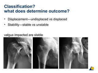 Femoral neck | PPT