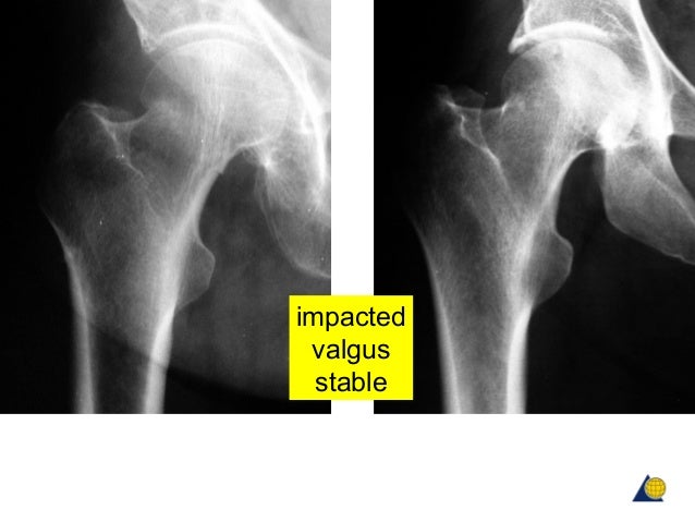 Varus Vs Valgus Fracture