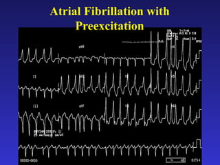 g459h_supraventricular-tachycardia ecg.pptx