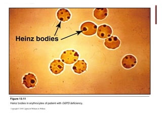 G6pd Deficiency Smear