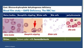 G6pd deficiency | PDF
