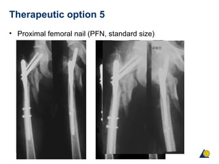 Subtrochanteric | PPT
