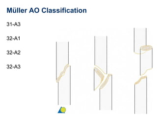 Subtrochanteric | PPT