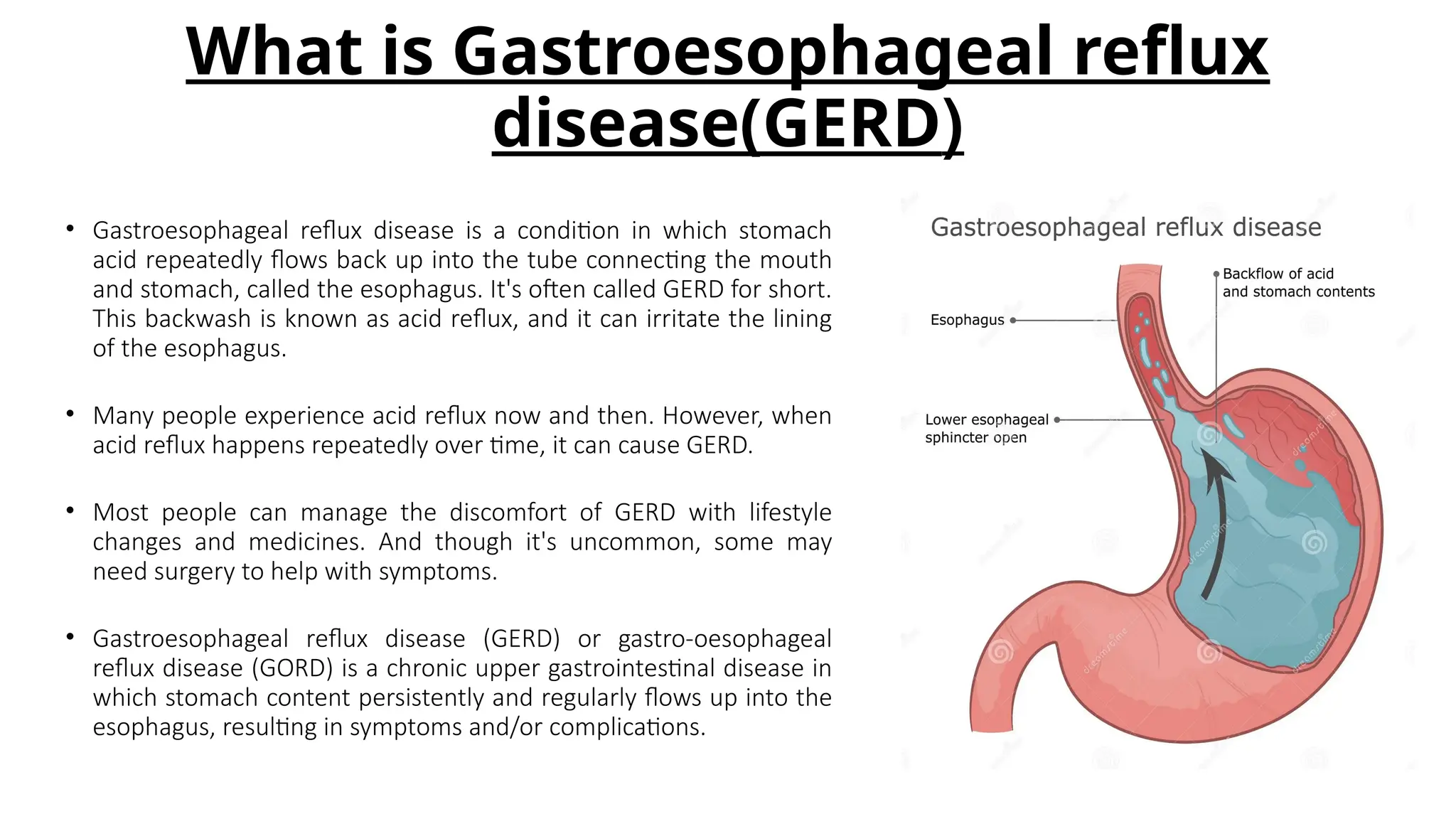 GAESTROESOPHAEGAL REFLUX DISEASE PROJECT | PPTX