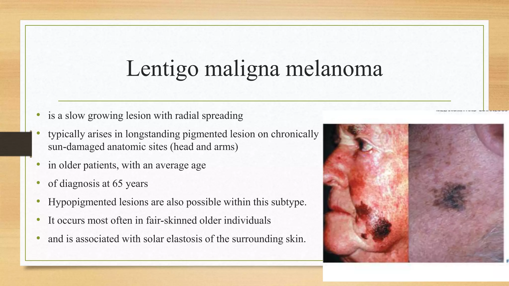 malignant melanoma | PPTX