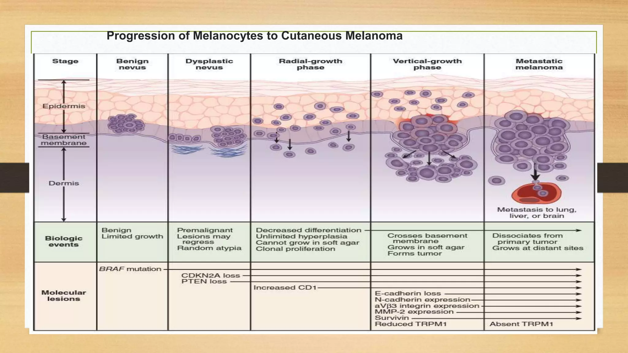 malignant melanoma | PPTX