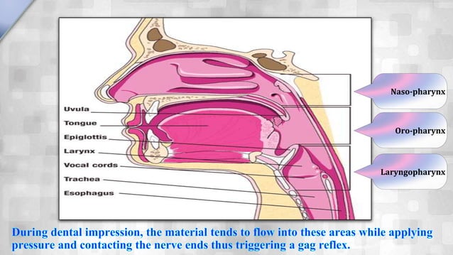Causes of Gagging reflex in impression taking | PPT