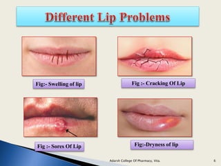 formulation and evaluation of medicated lipstick | PDF