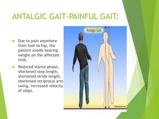 Antalgic Gait