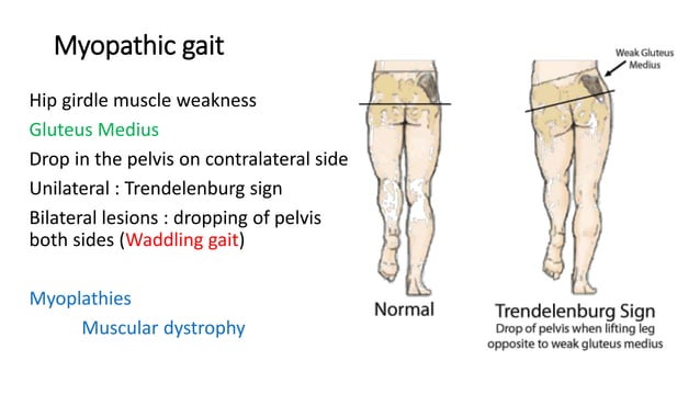 Gait abnormalities | PPTX