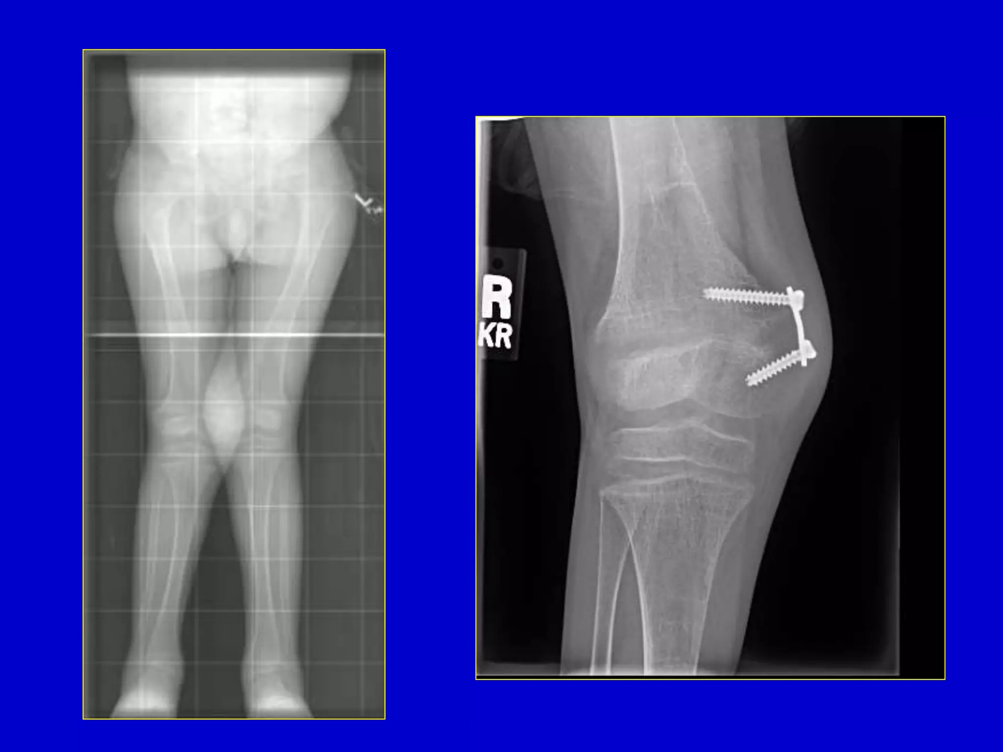 gait abnormalities in children.ppt