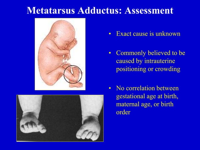 gait abnormalities in children.ppt | Physical Therapy | Wellness