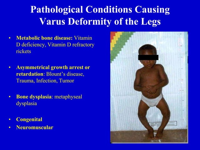 gait abnormalities in children.ppt | Physical Therapy | Wellness
