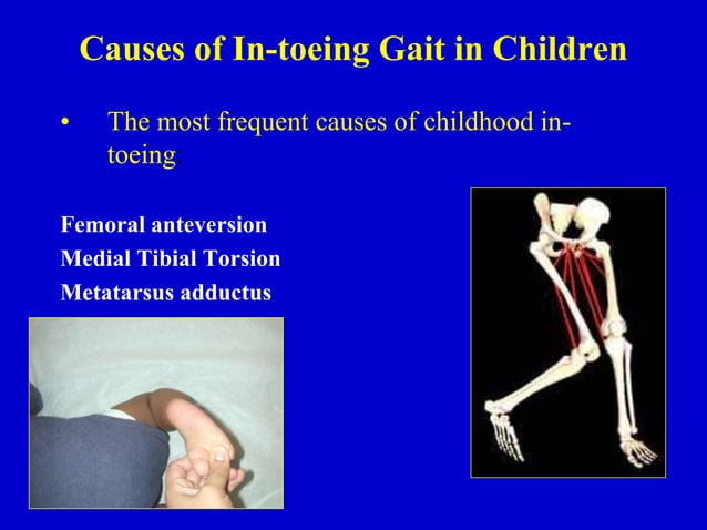 gait abnormalities in children.ppt | Physical Therapy | Wellness