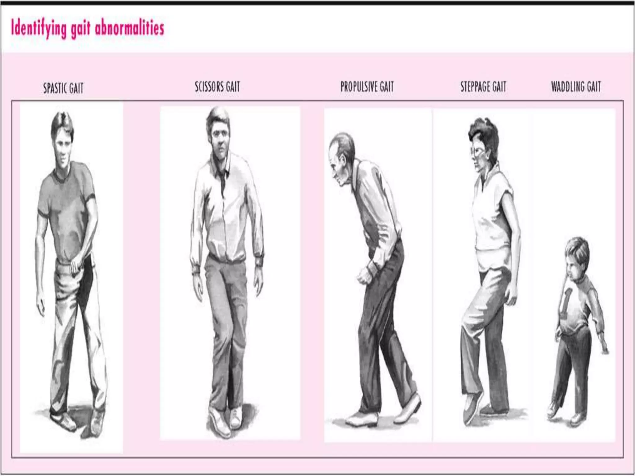 Gait abnormalities presentation | PPTX