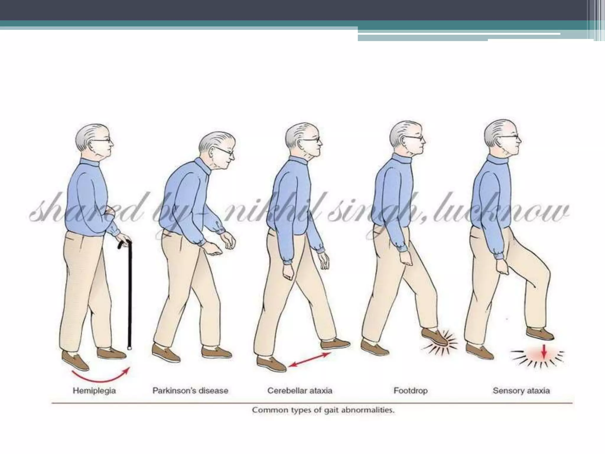 Gait abnormalities presentation | PPTX
