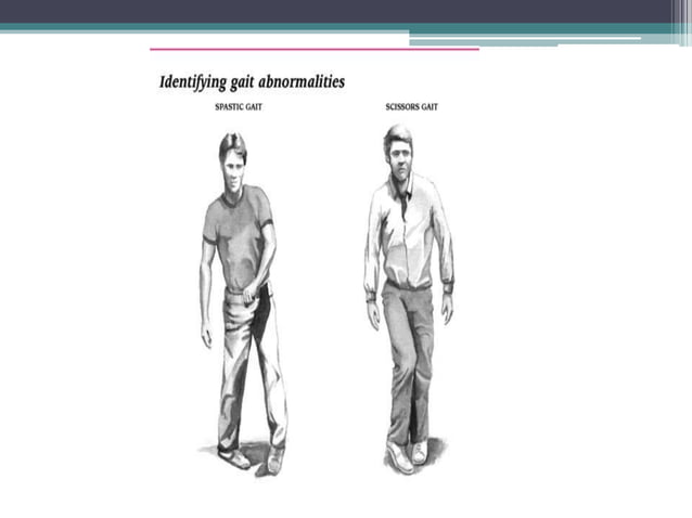 Gait abnormalities presentation