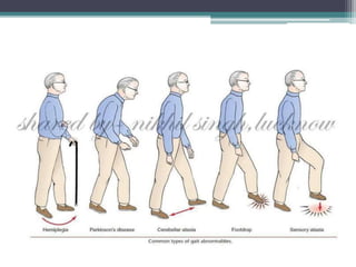 Gait abnormalities presentation | PPT