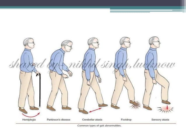 Gait abnormalities presentation