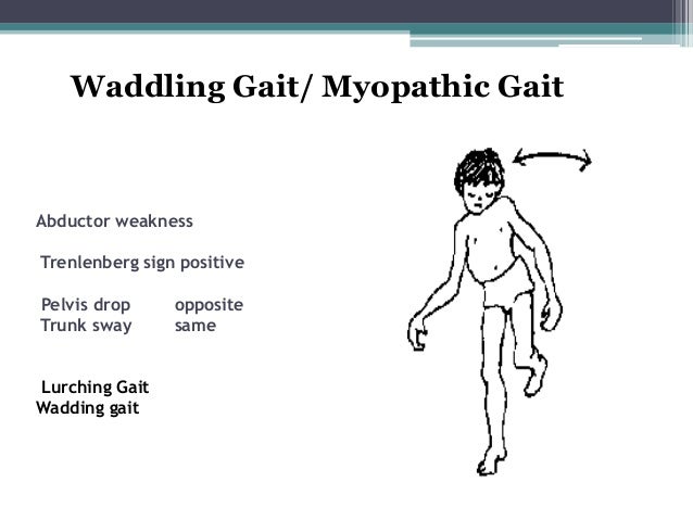 Gait abnormalities presentation
