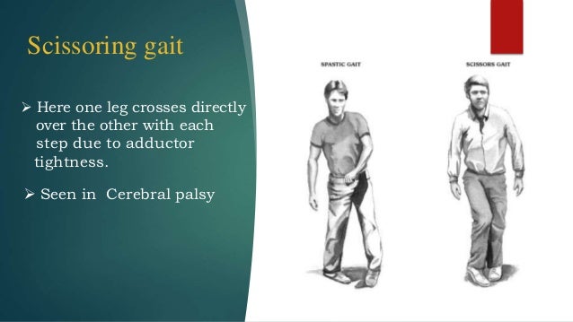Gait and its abnormalities
