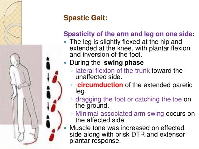 Gait disorders