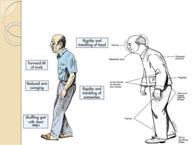 Gait Disorders