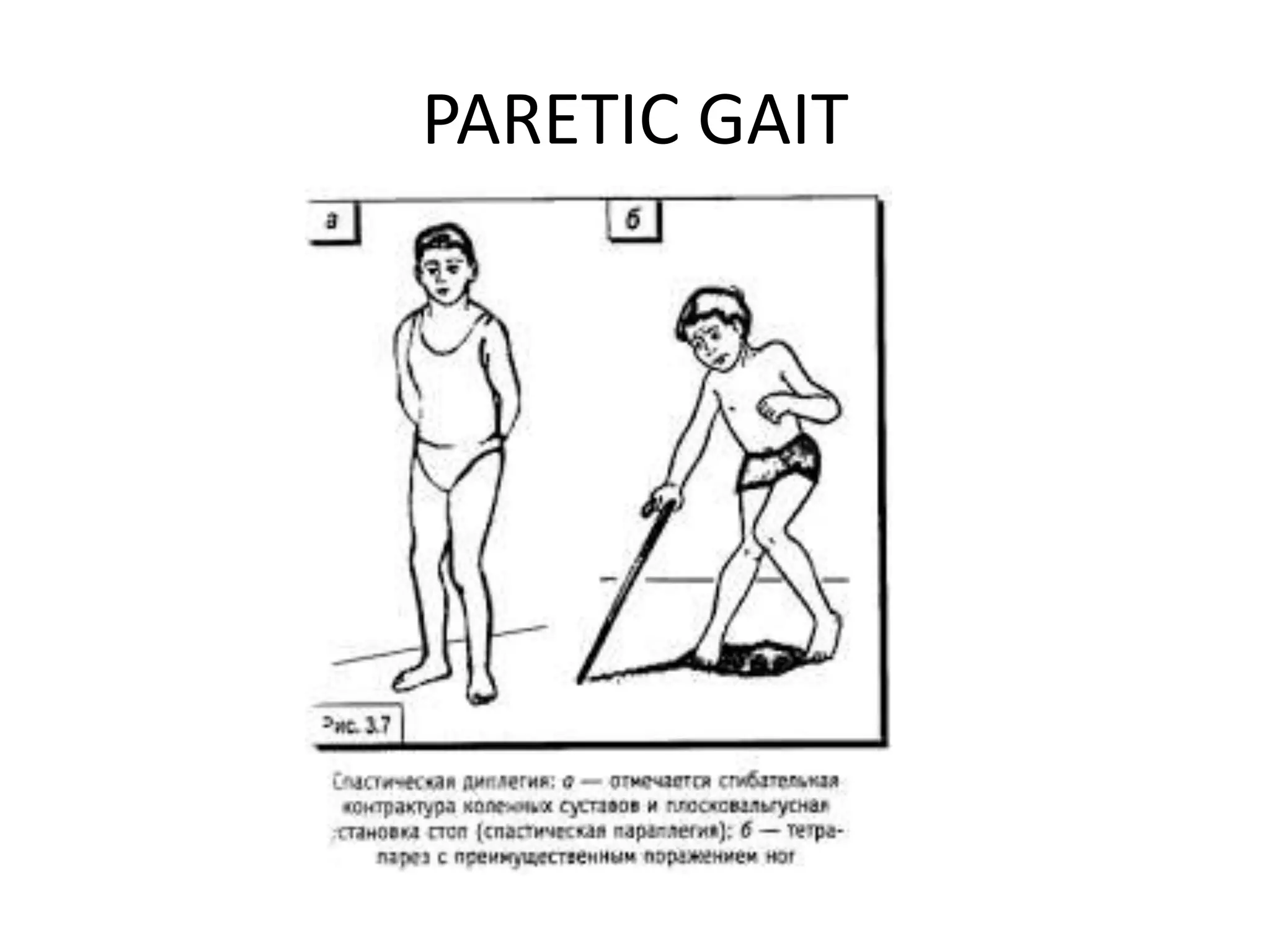 Gait disorders.pptx