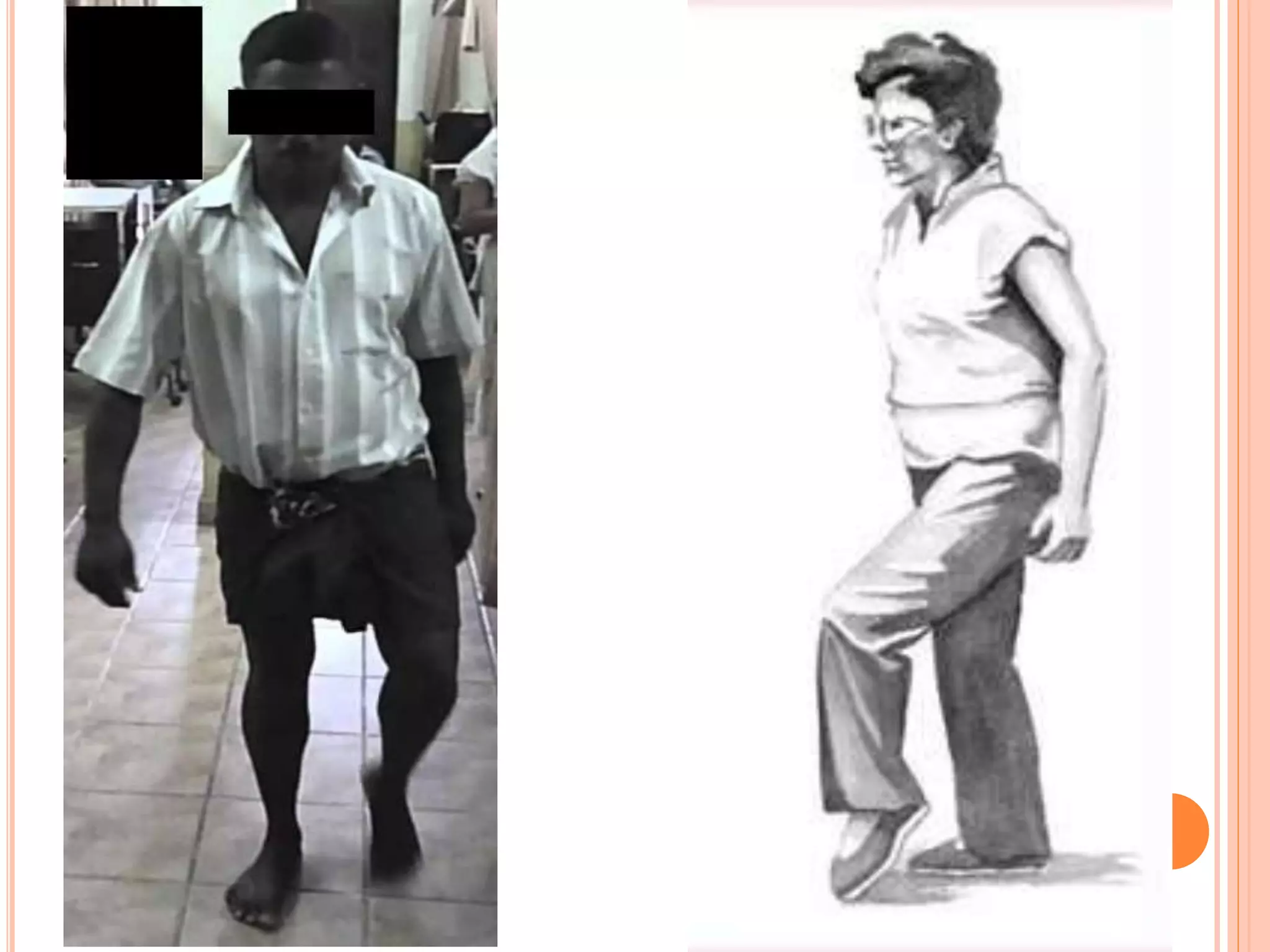 Gait abnormalities | PPSX