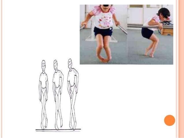 Gait abnormalities