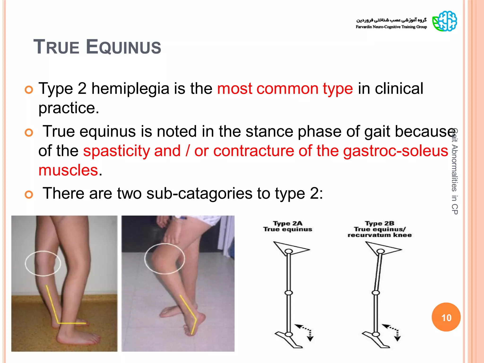 Gait pattern classification in children with cp | PDF