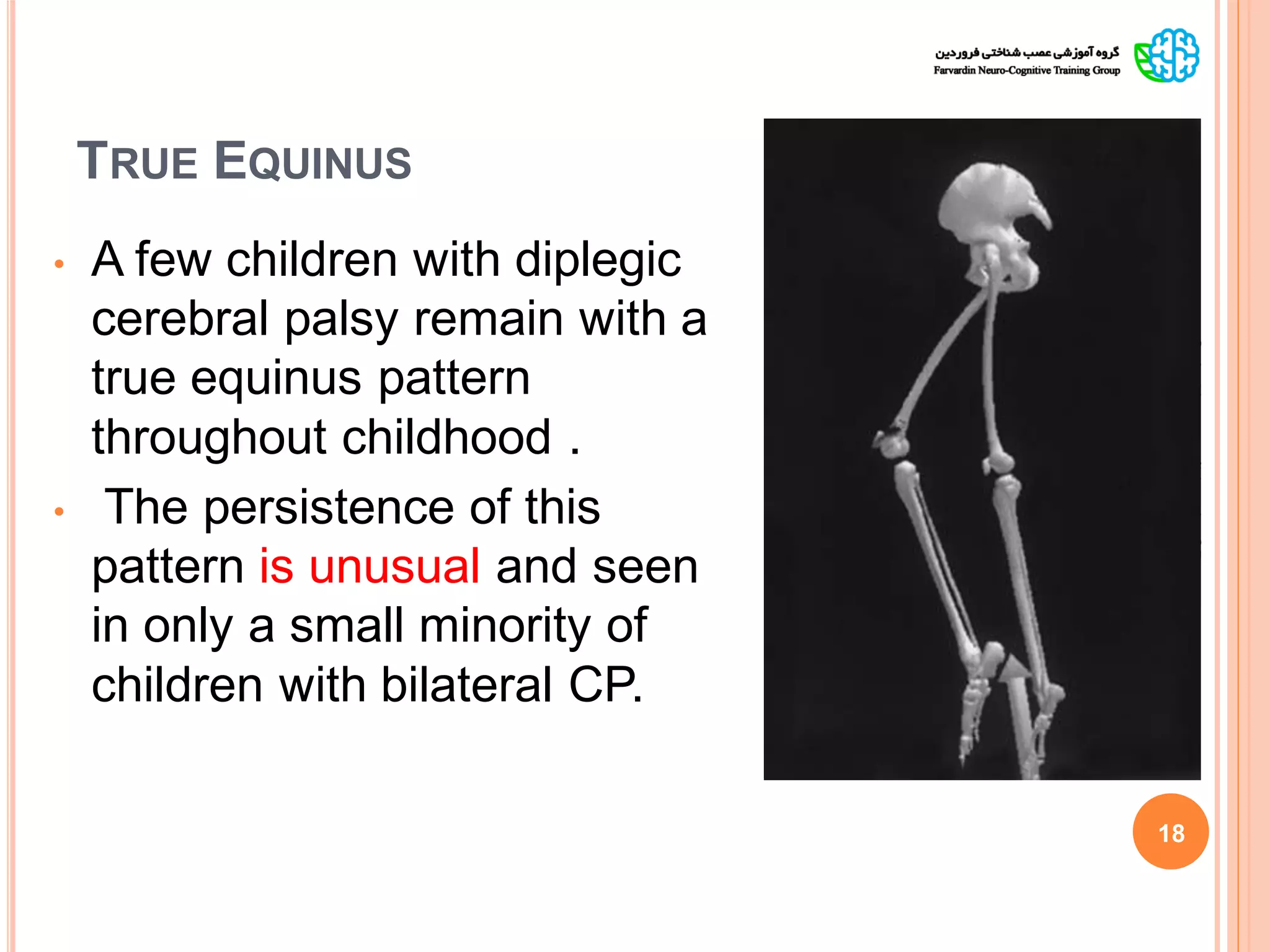 Gait pattern classification in children with cp | PDF