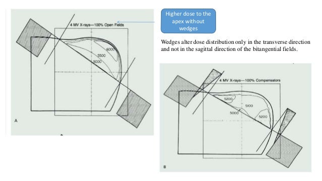 radiation therapy in ca breast