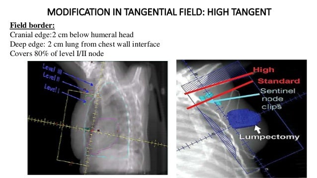 radiation therapy in ca breast
