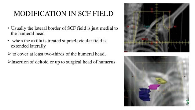 radiation therapy in ca breast