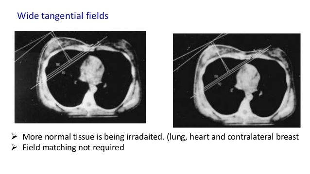 radiation therapy in ca breast