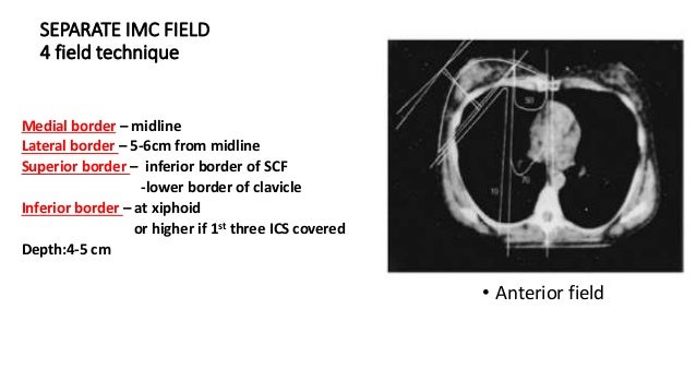 radiation therapy in ca breast