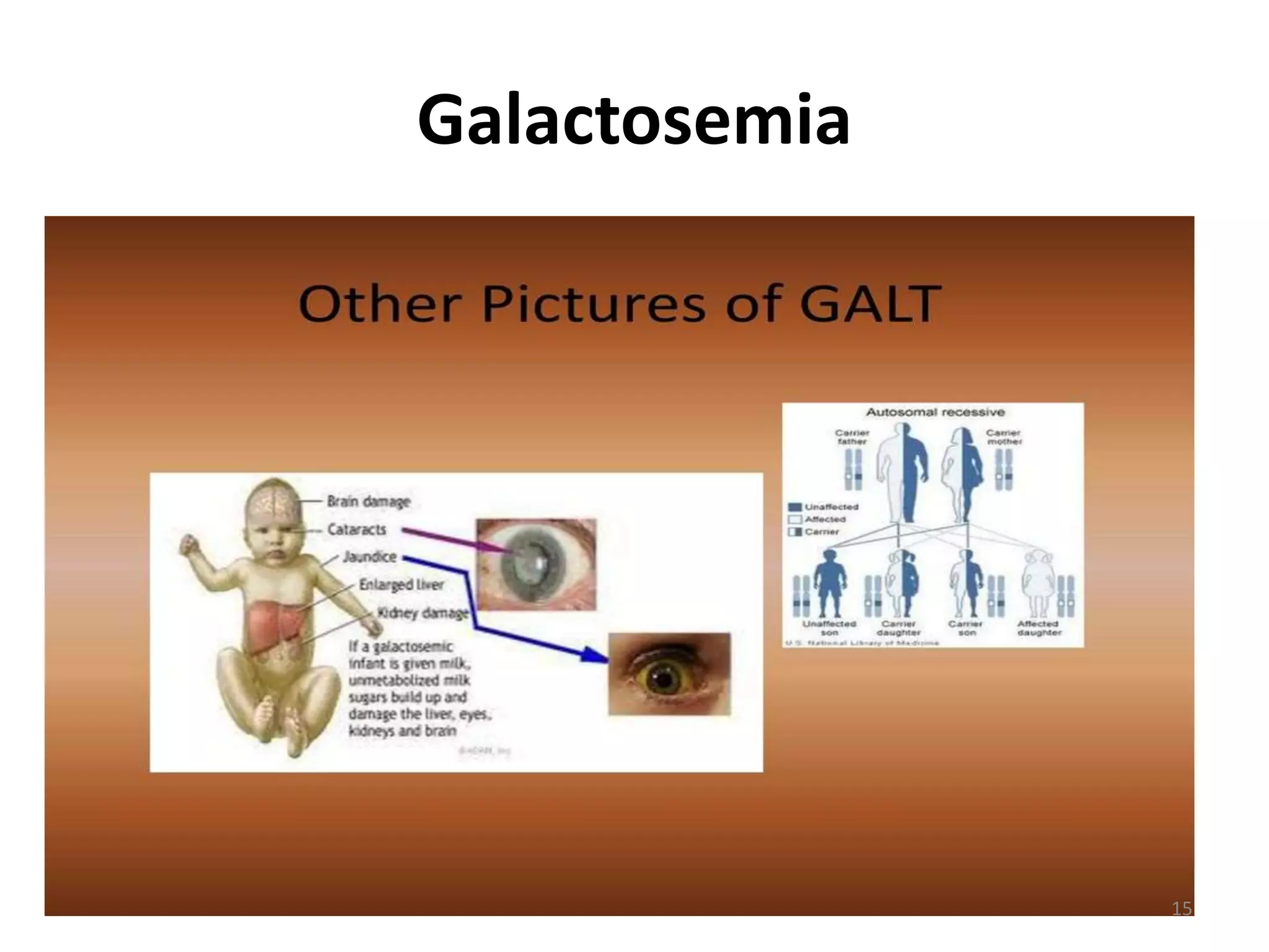 Galactosemia | PPTX