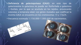 Galactosemia final | PPTX