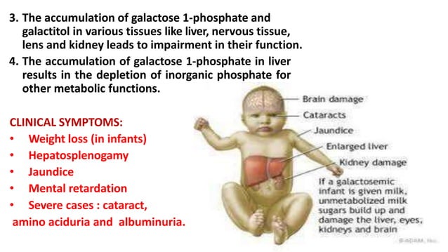 Galactosemia ppt