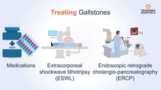 Extracorporeal Shock Wave Lithotripsy For Gallstones