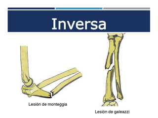 Galeazzi | PPTX