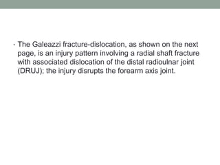 Galeazzi Fracture | PPTX