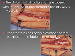 Galeazzi fracture..23