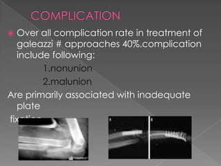 Galeazzi fracture..23