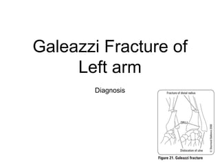 Galeazzi fracture | PPTX