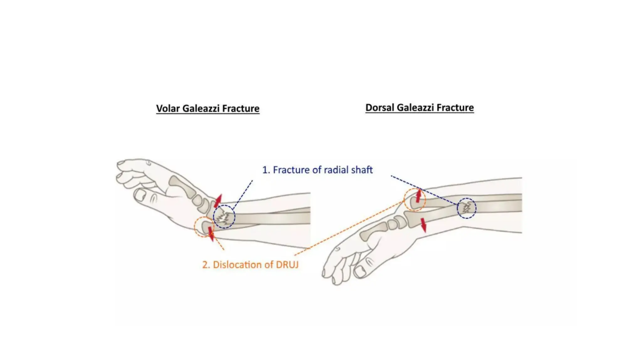 galeazzi fracture and upper limb fracture. | PPT
