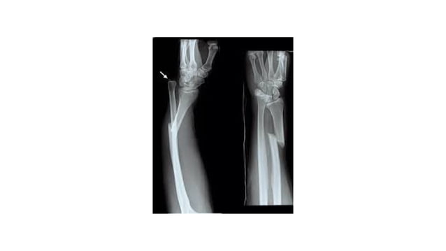 galeazzi fracture and upper limb fracture. | PPTX