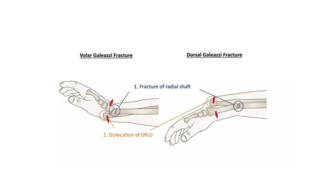 galeazzi fracture and upper limb fracture. | PPTX