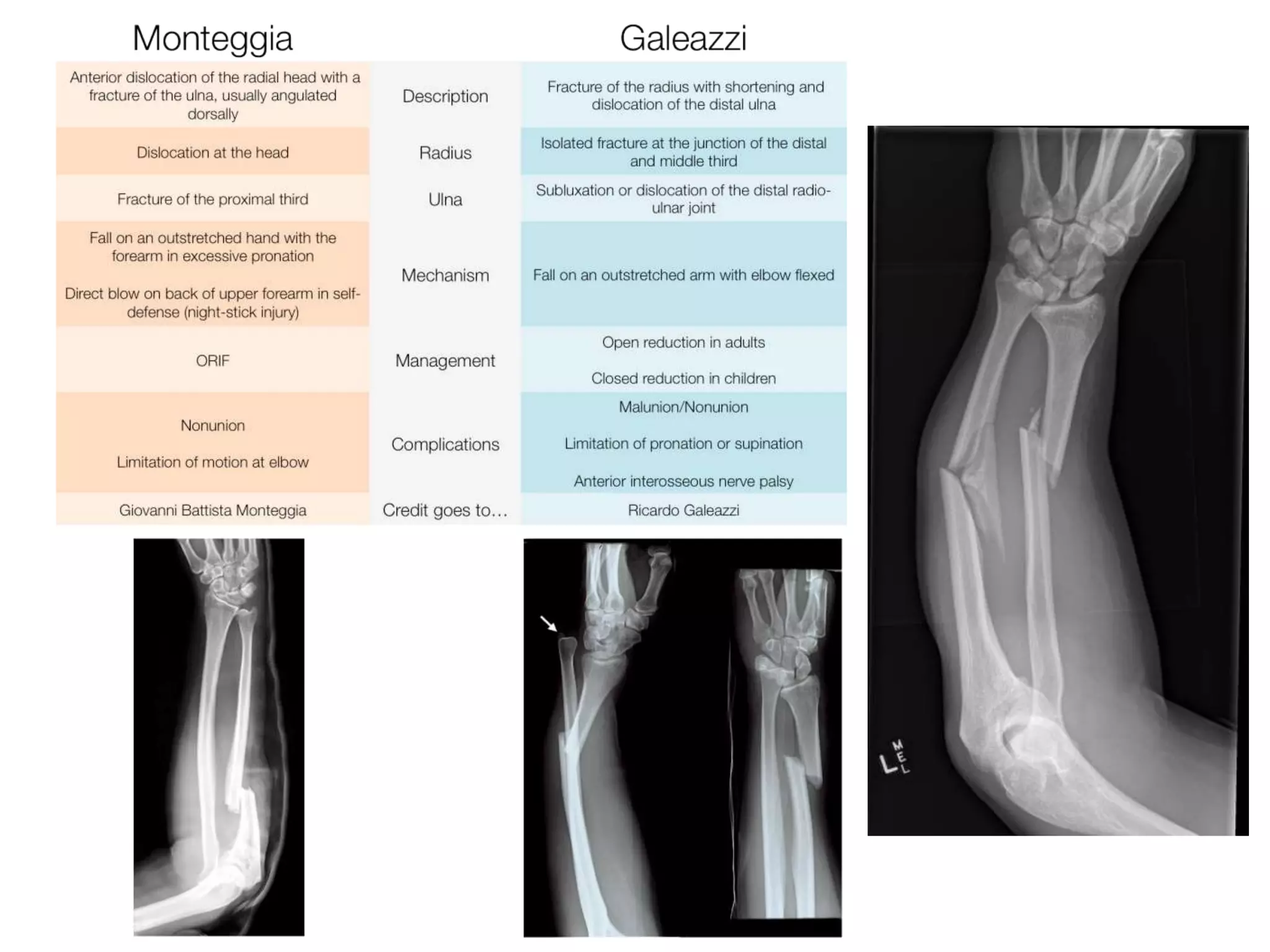 Galeazzi fracture dislocation | PPTX